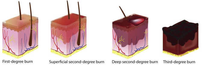 Hyperbaric Oxygen Therapy(HBOT) for Thermal/ Extensive Burns in Aurangabad